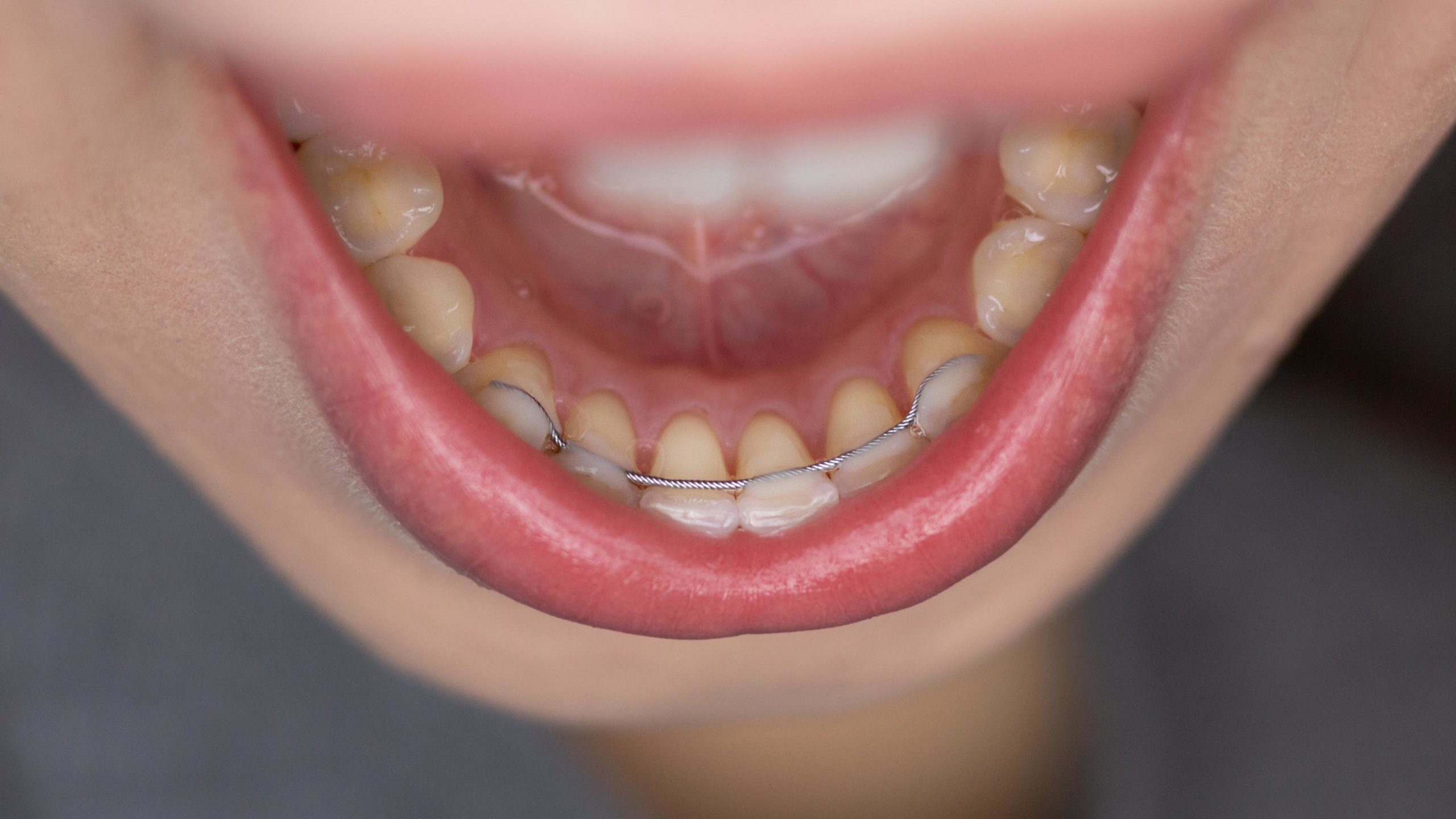 How to Fix a Broken Retainer Wire at Home | Westrock Ortho