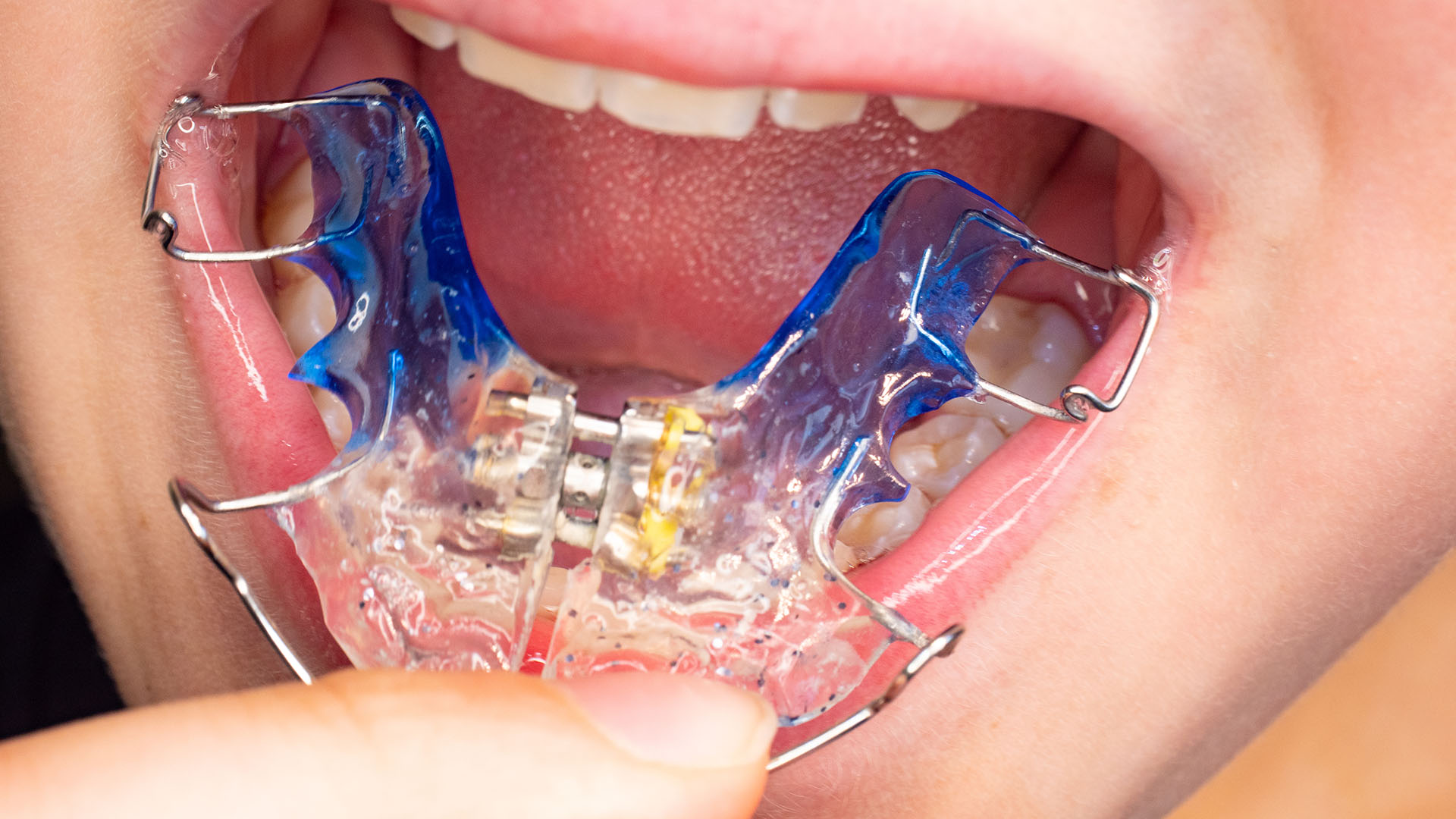 Using an Orthodontic Expander | A Guide on Palatal Expanders