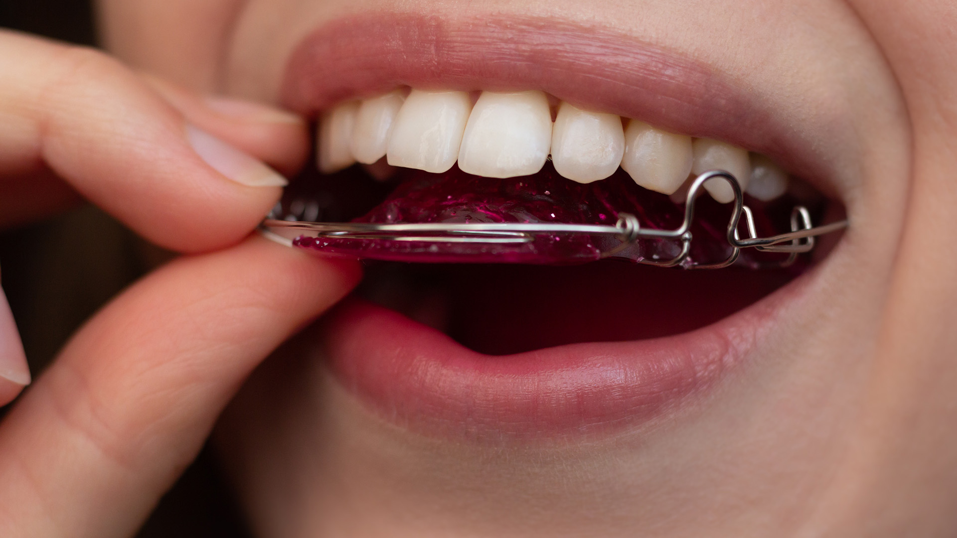 What to Do if Your Retainer Breaks | Your Complete Guide