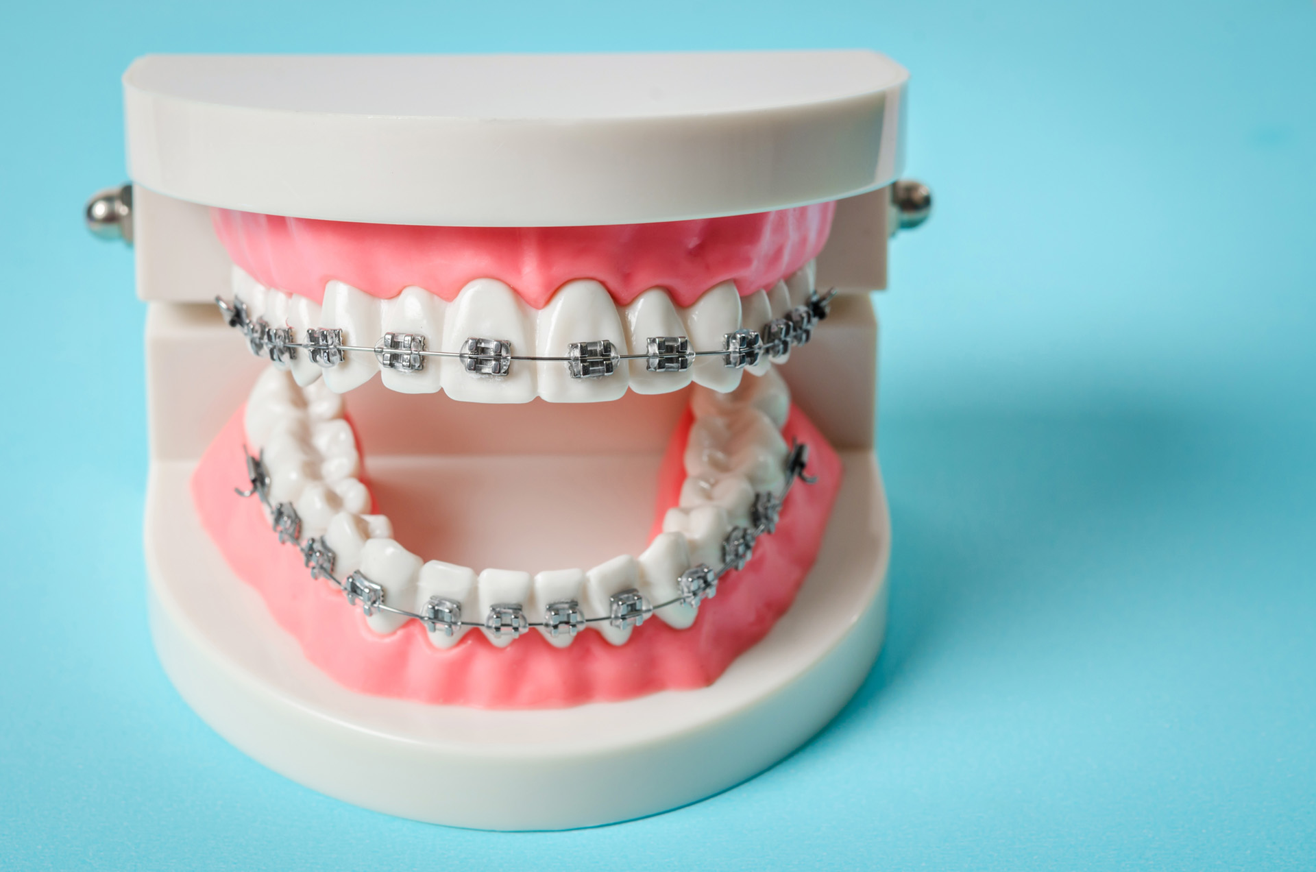 What Happens If You Don’t Get Braces? A Complete Guide